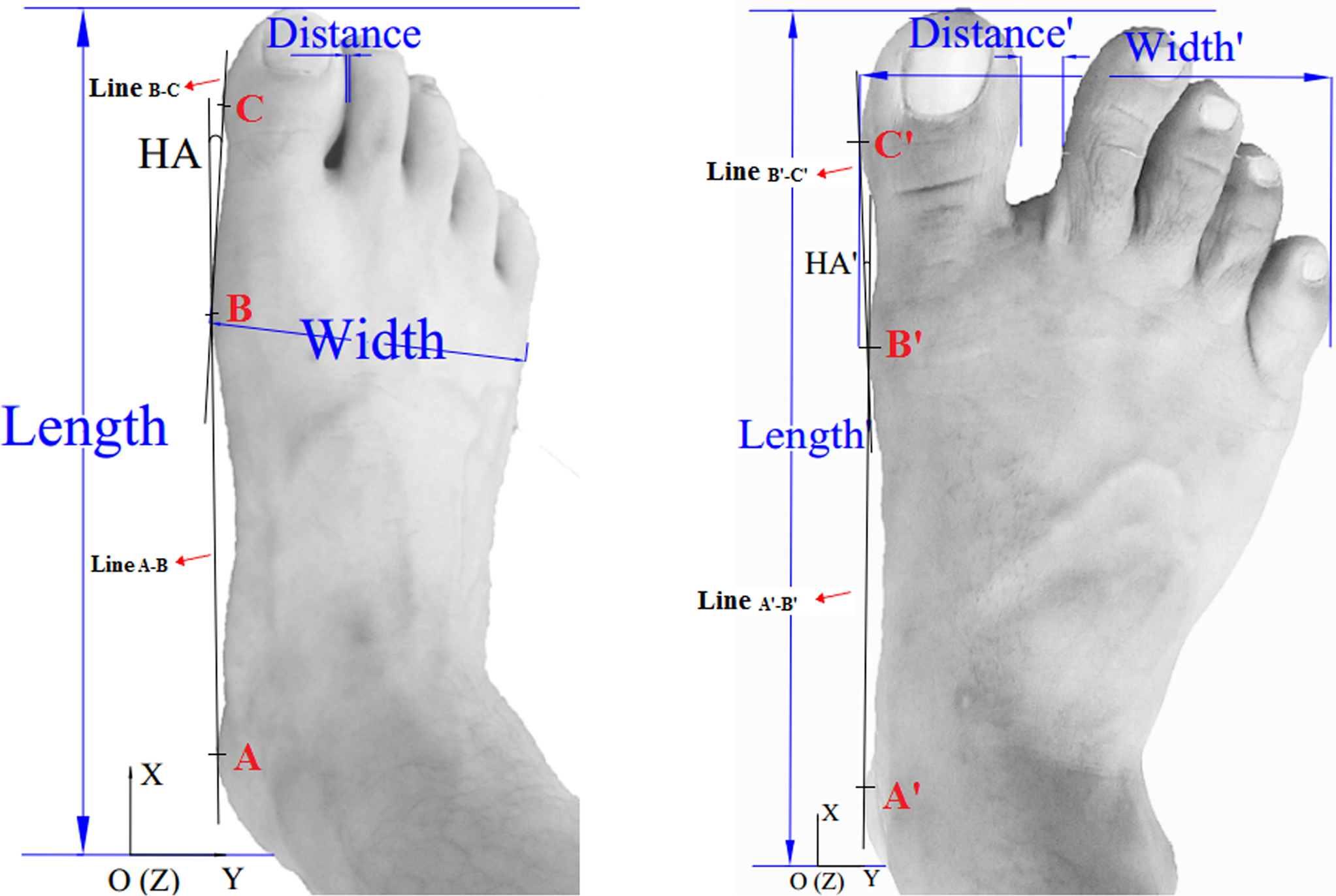 Make the Great Toe Great Again. On Bunions and Overpronation